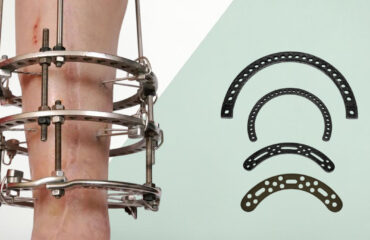 Types of External Fixators in Orthopedics - HEMC Ortho