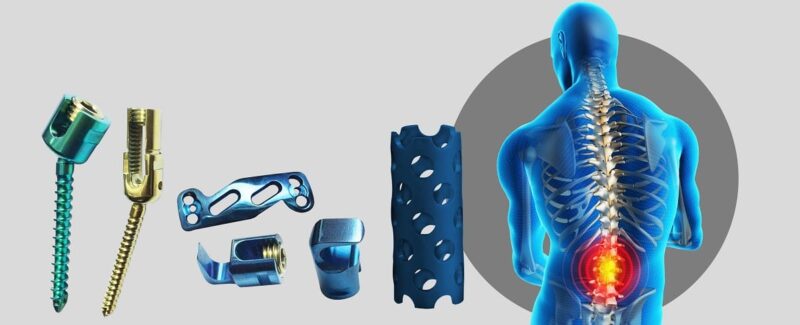 What are Spine Implants and their Types & Benefits? - HEMC Ortho