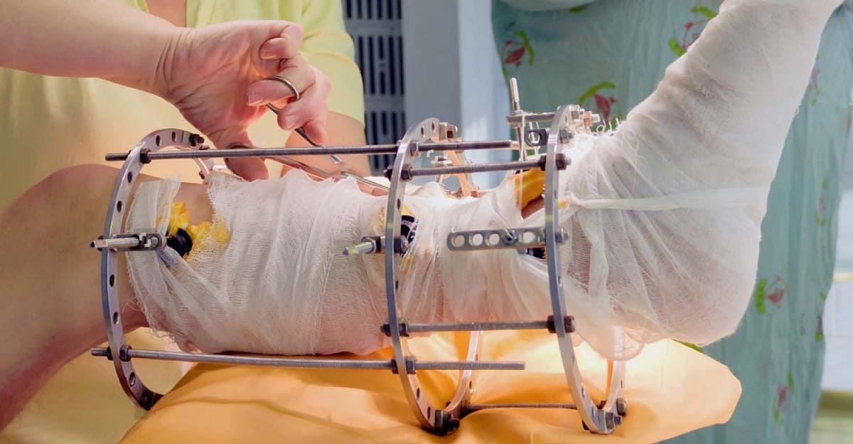 Types Of External Fixators In Orthopedics Hemc Ortho