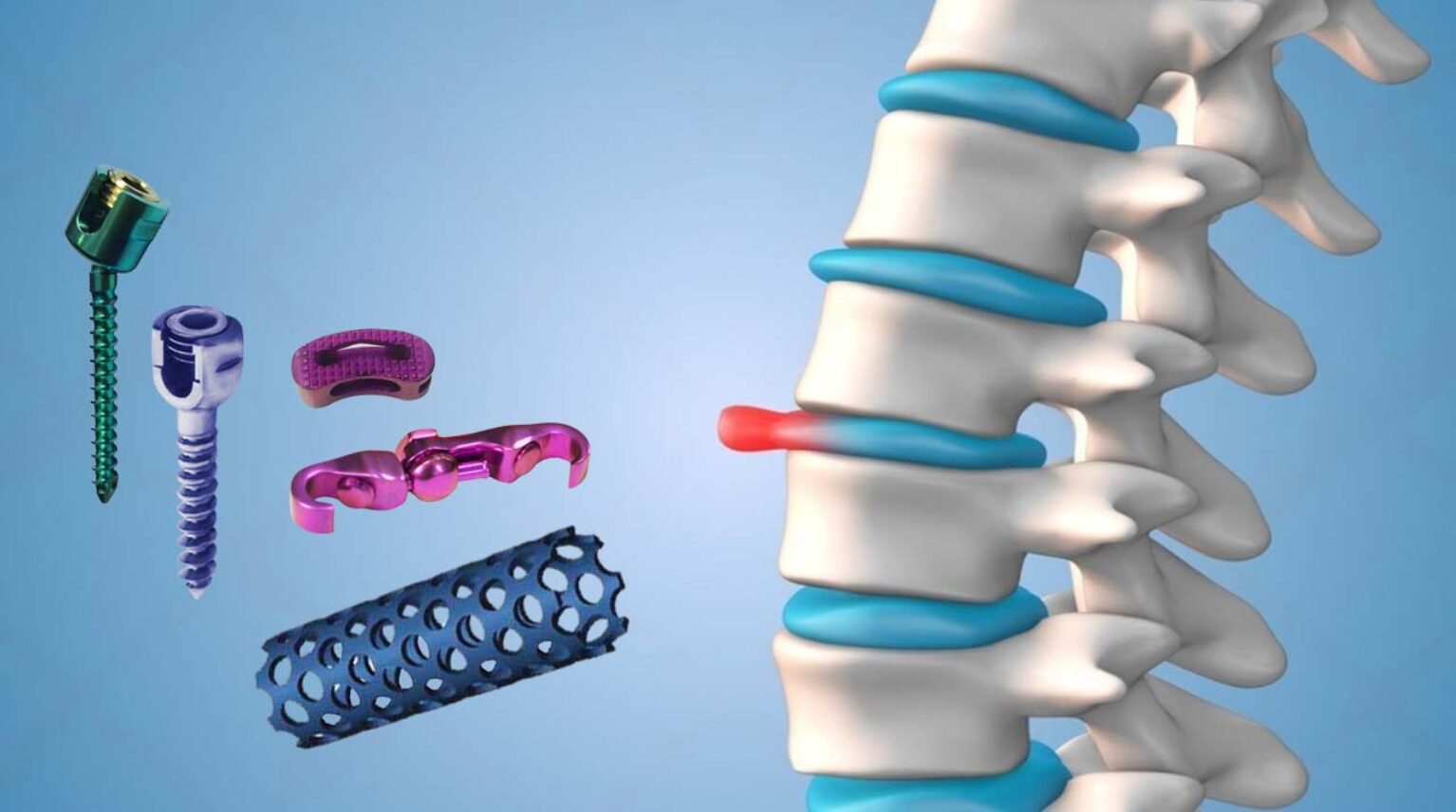 A Guide to Choosing the Right Spine Implants - HEMC Ortho