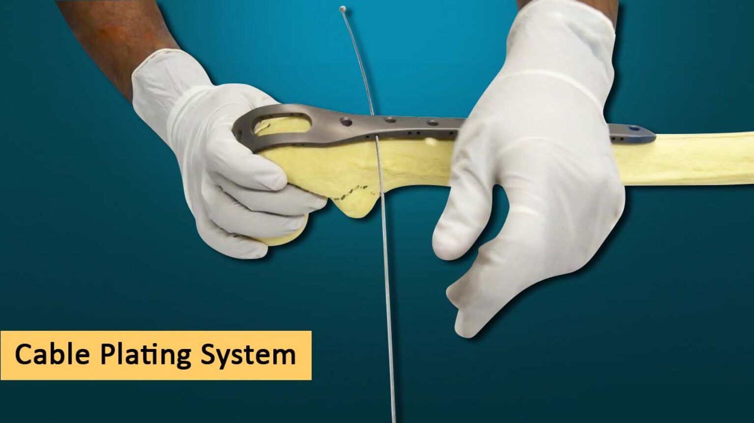 Cable Plating System – A Detailed Overview - HEMC Ortho
