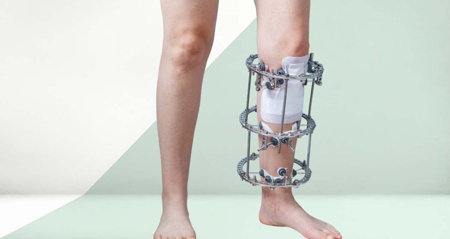 External Fixators India – Perfect Solution to External Bone Fractures ...